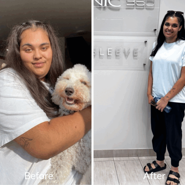 Before & After Photos - Gastric Sleeve Surgery - 360 Sleeve