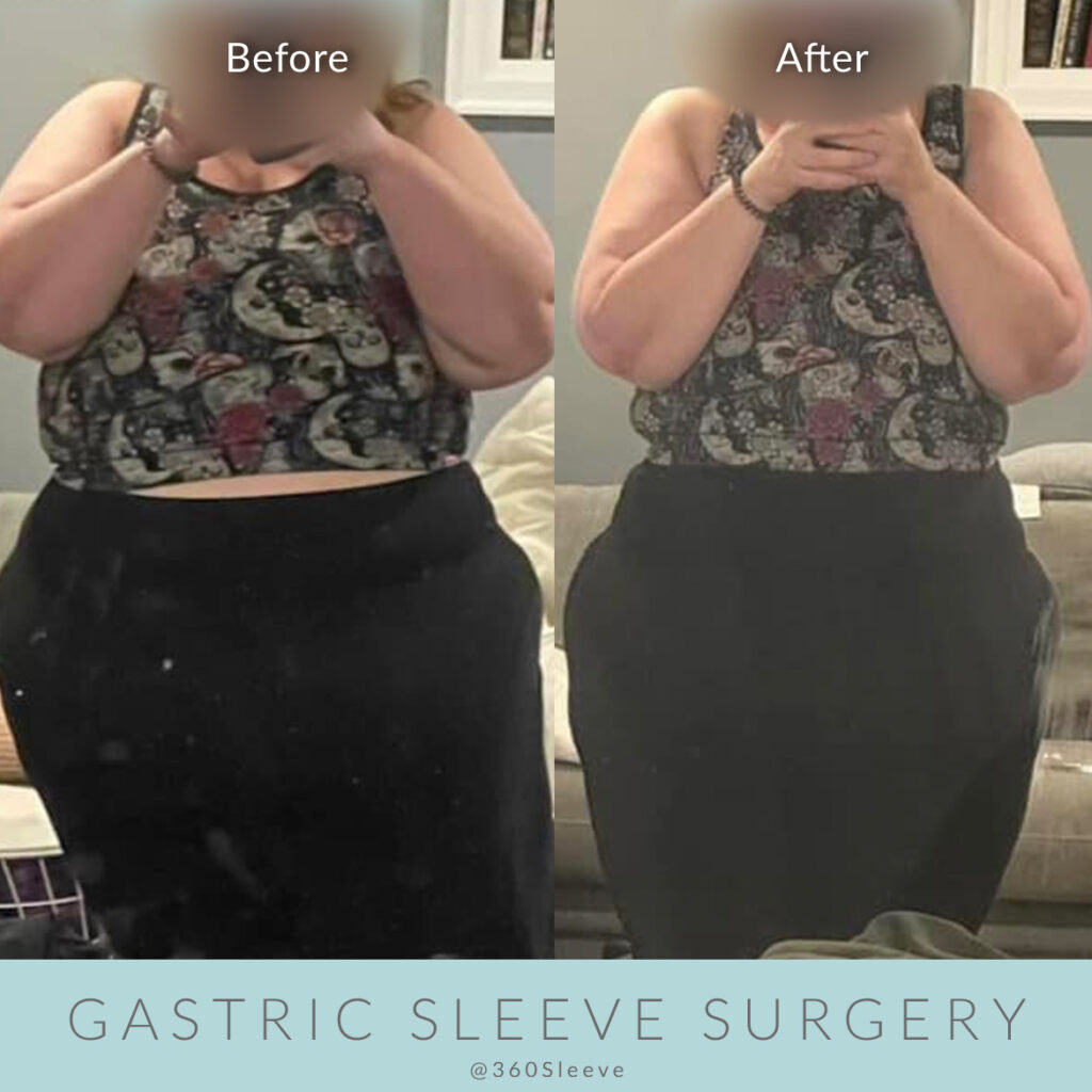 Before & After Photos - Gastric Sleeve Surgery - 360 Sleeve