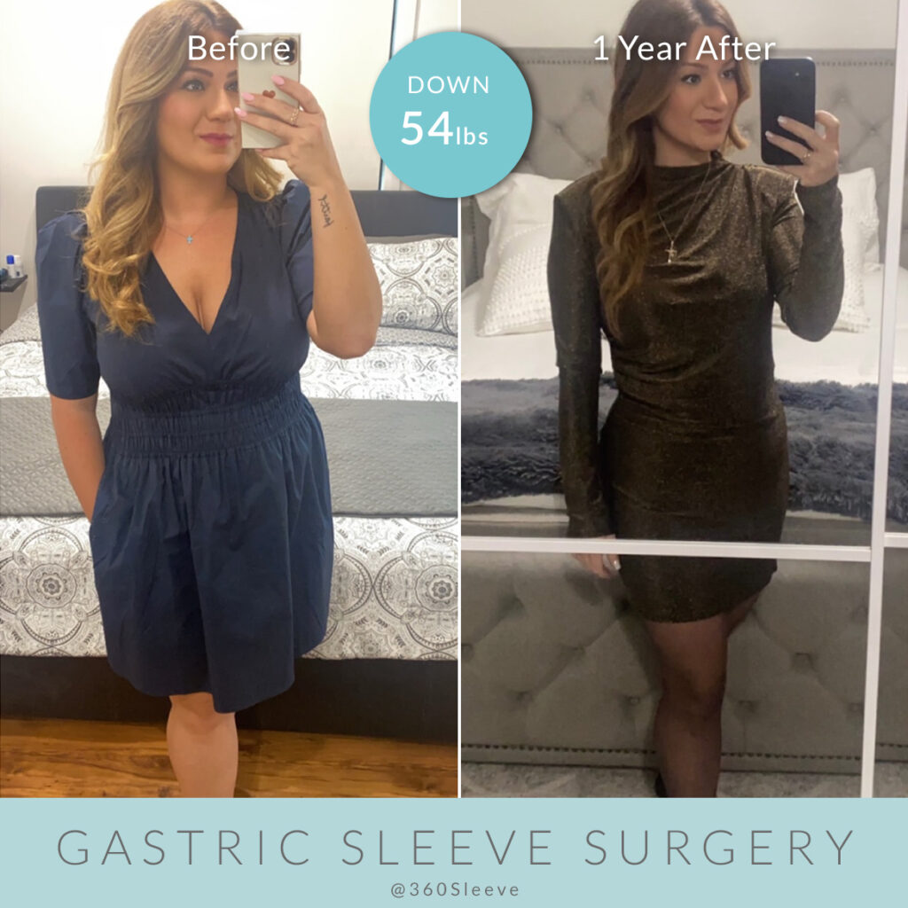 Before & After Photos - Gastric Sleeve Surgery - 360 Sleeve